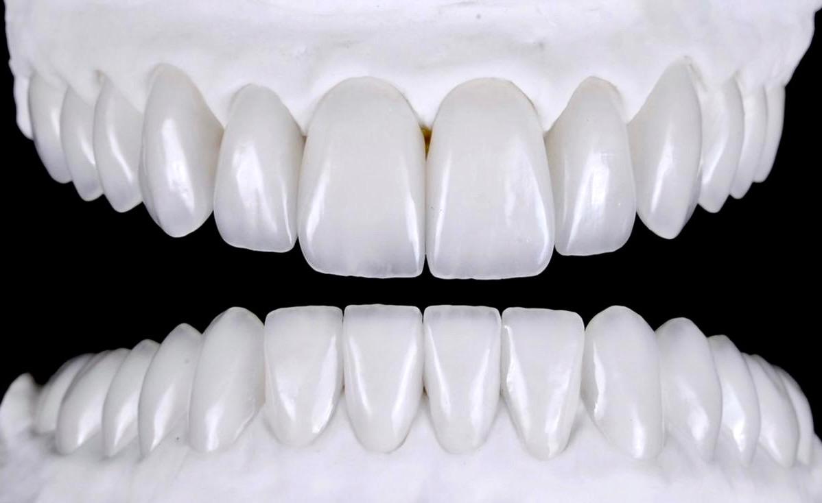 Korona - e.max - cutback – CadMe